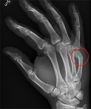 Brudd i 5. mellomhåndsben - Sykehuset i Vestfold HF